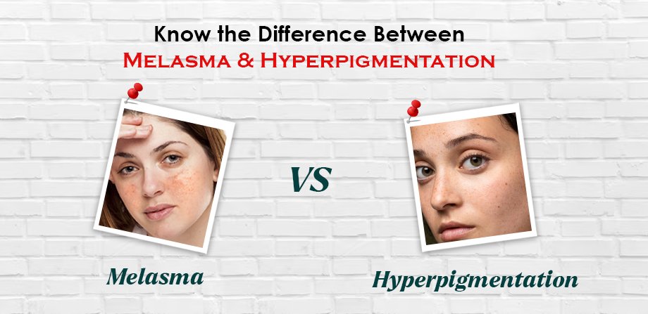 Know the Difference Between Melasma and Hyperpigmentation